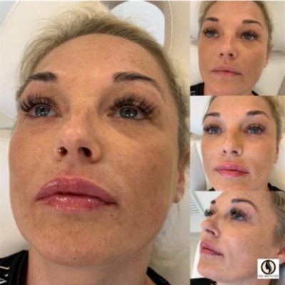 Lip Fillers Leicester | Lip Enhancement | Face Aesthetics